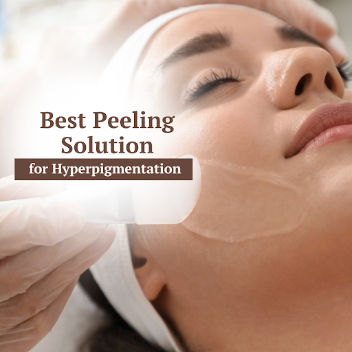 Best Peeling Solution for Hyperpigmentation – Organic Skin Lightener